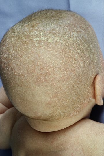 Seborrhoïsch eczeem - Huidhuis